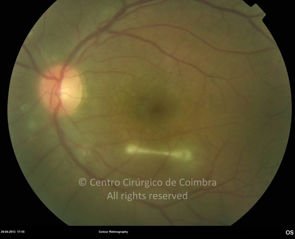 Caso clínico 1 - Atlas RL Eye