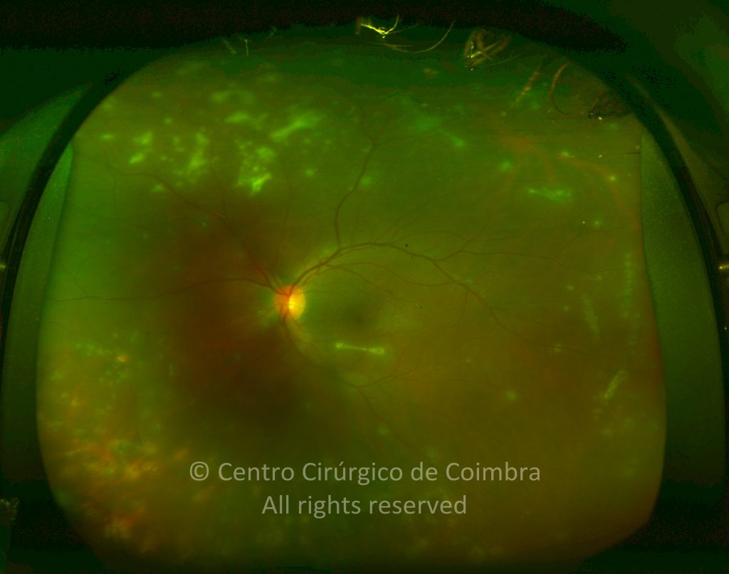 Caso Clínico 1 – Atlas RL Eye