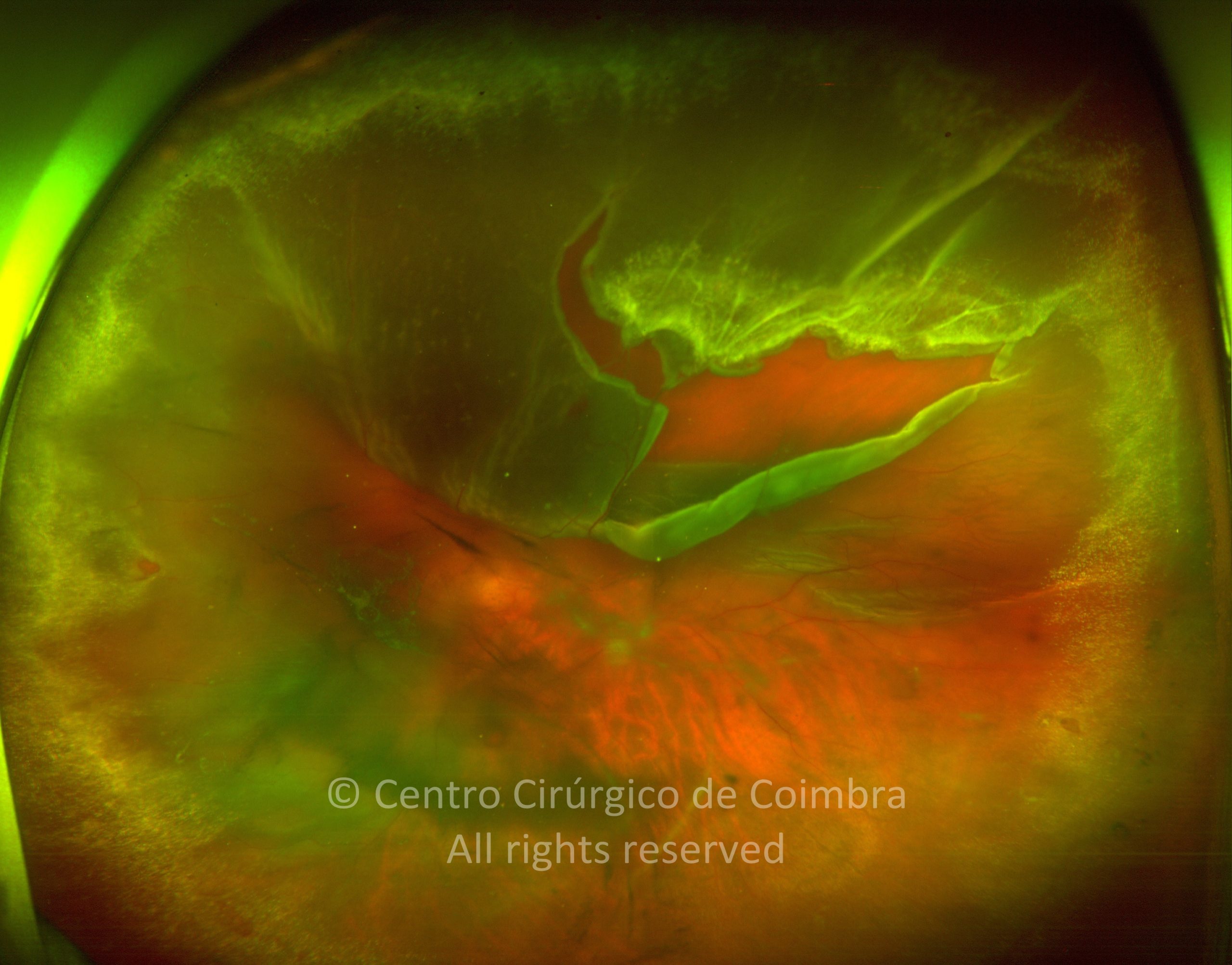 Rhegmatogenous Retinal Detachment - Atlas RL Eye