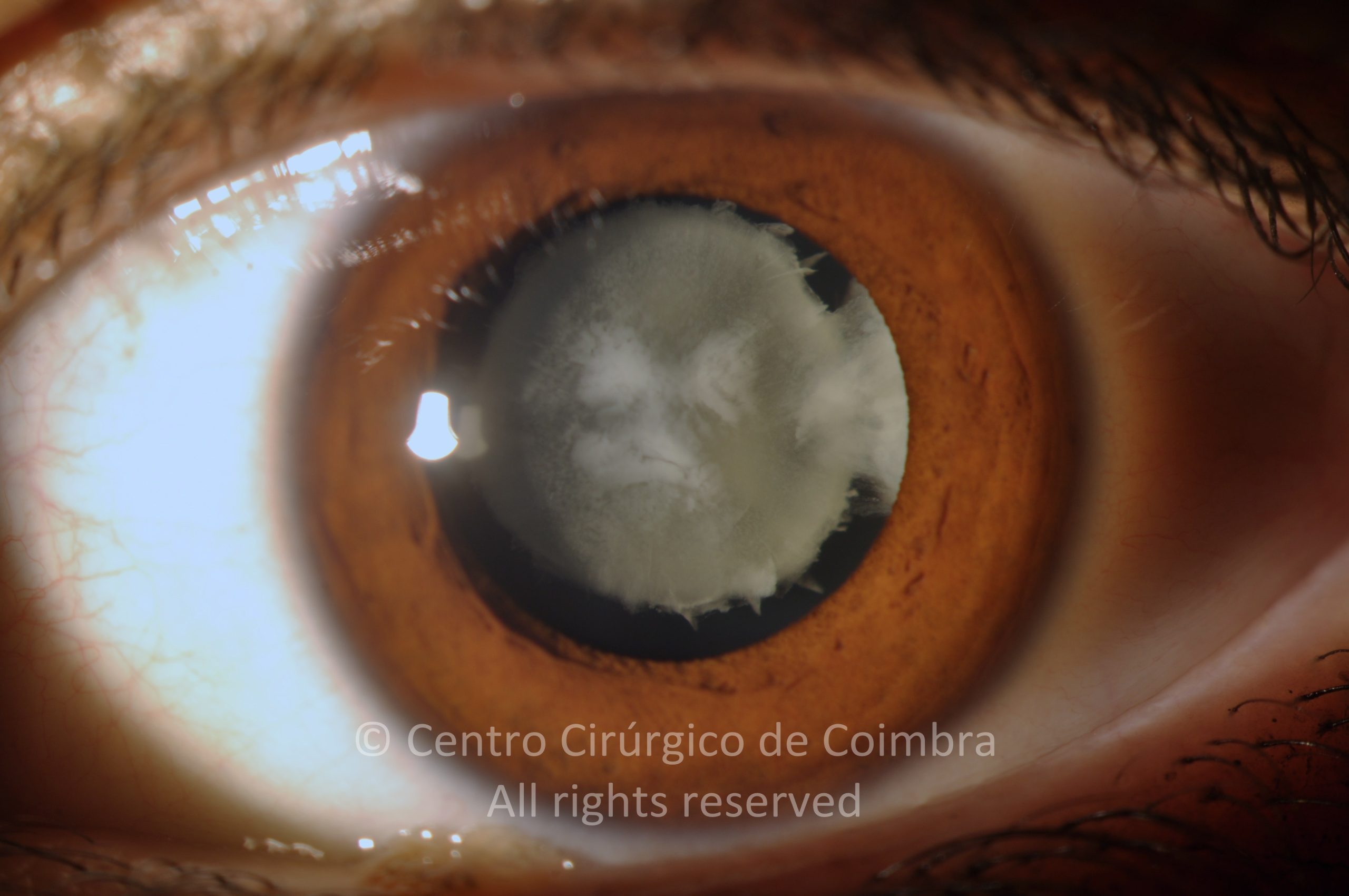 Congenital cataract – Atlas RL Eye