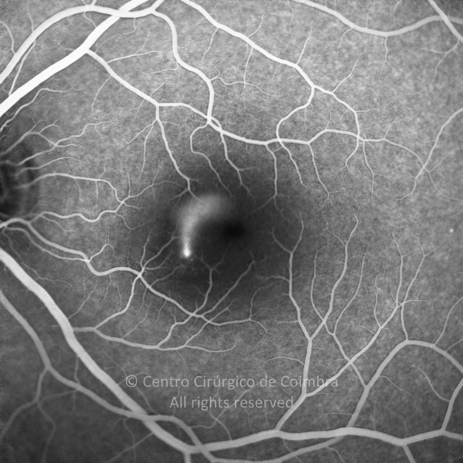 Central Serous Chorioretinopathy; typical leakage in fluorescein ...