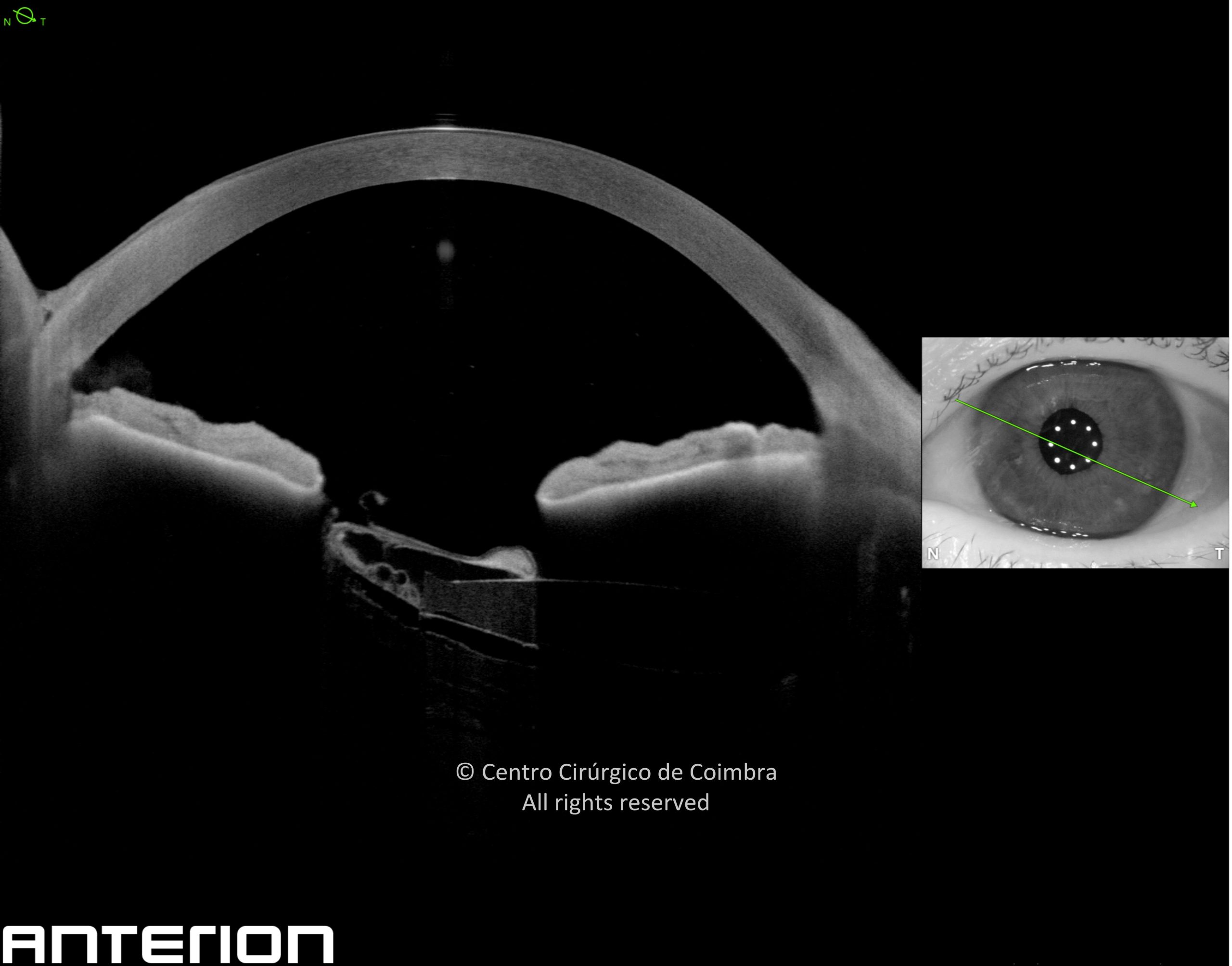 Luxation of the capsular bag and intraocular lens – Atlas RL Eye