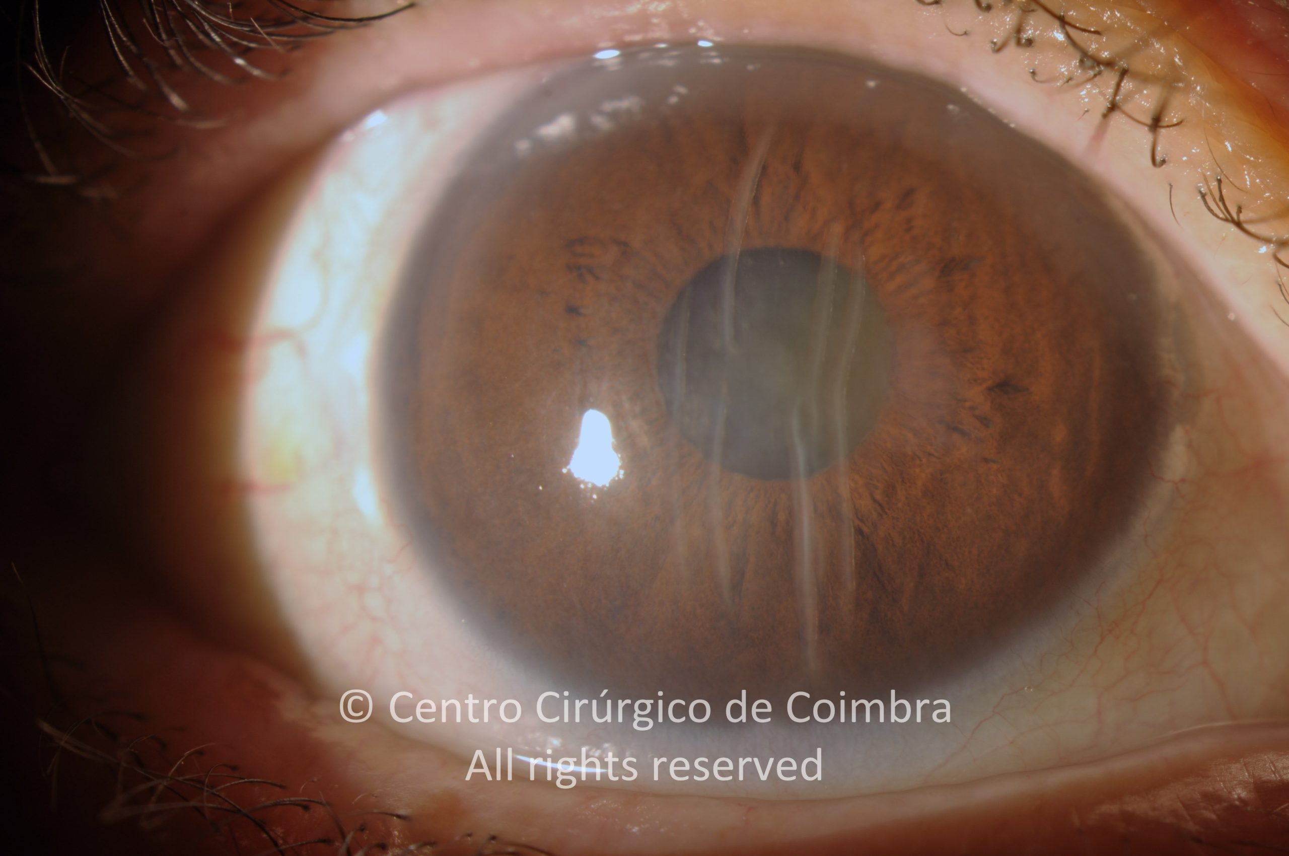 Forceps trauma – Atlas RL Eye