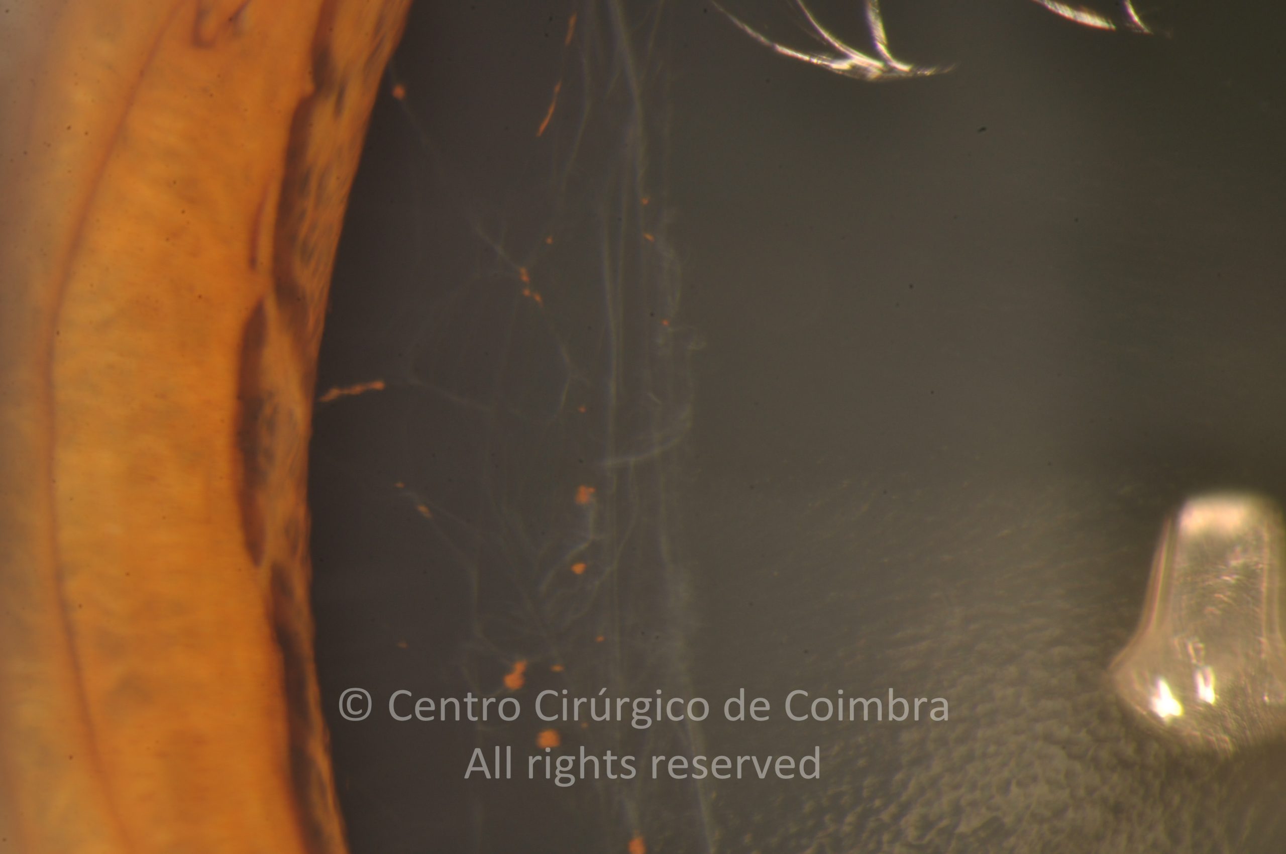 Persistent Pupillary Membrane – Atlas RL Eye