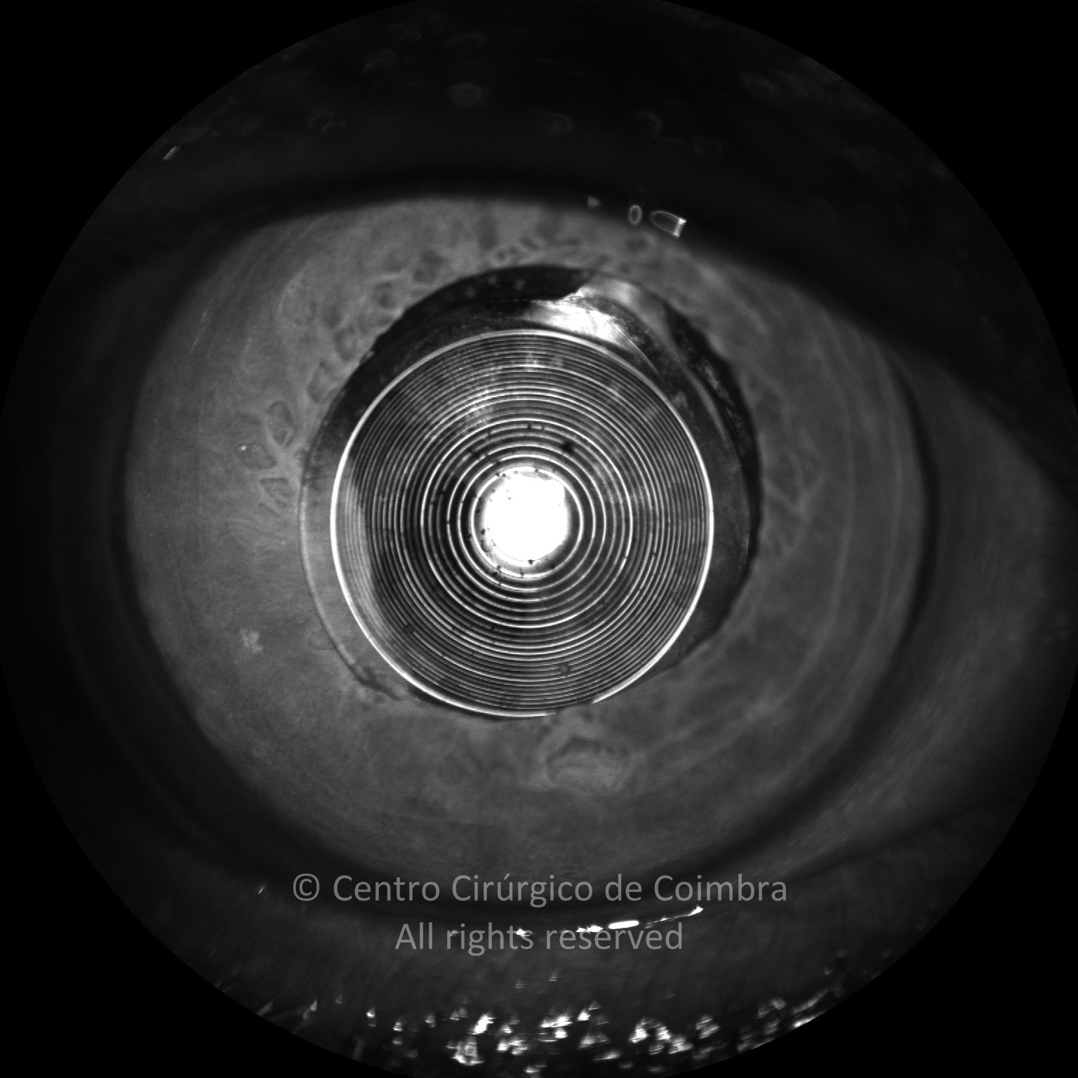 Multifocal intraocular lens – Atlas RL Eye